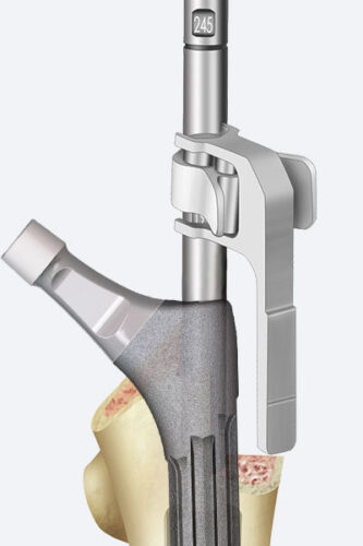 Alteon Monobloc Revision Femoral Stem | Advita Ortho