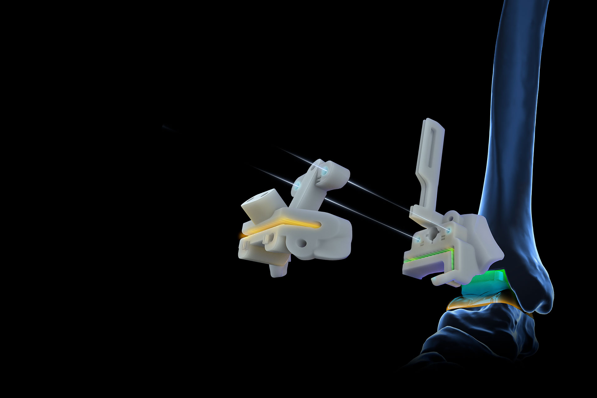 Vantage Ankle Patient Specific Instrumentation | Advita