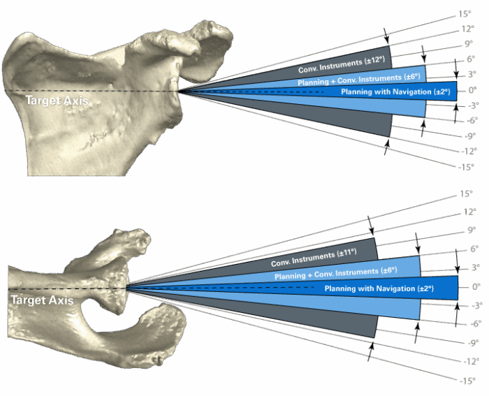 GPS Shoulder | Advita Ortho