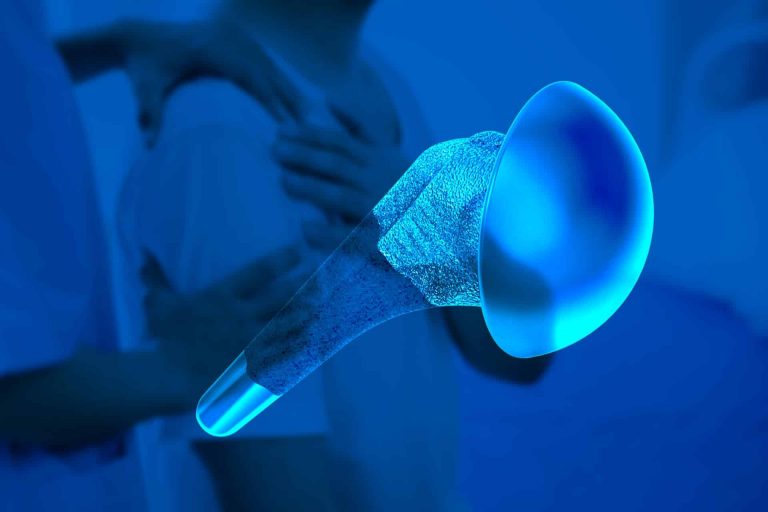 Evaluating Pyrocarbon Shoulder Hemiarthroplasty: Benefits and Drawbacks ...