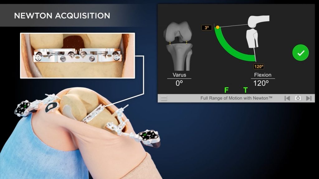 GPS Knee Animation: Newton Balancing Technology | Advita Ortho